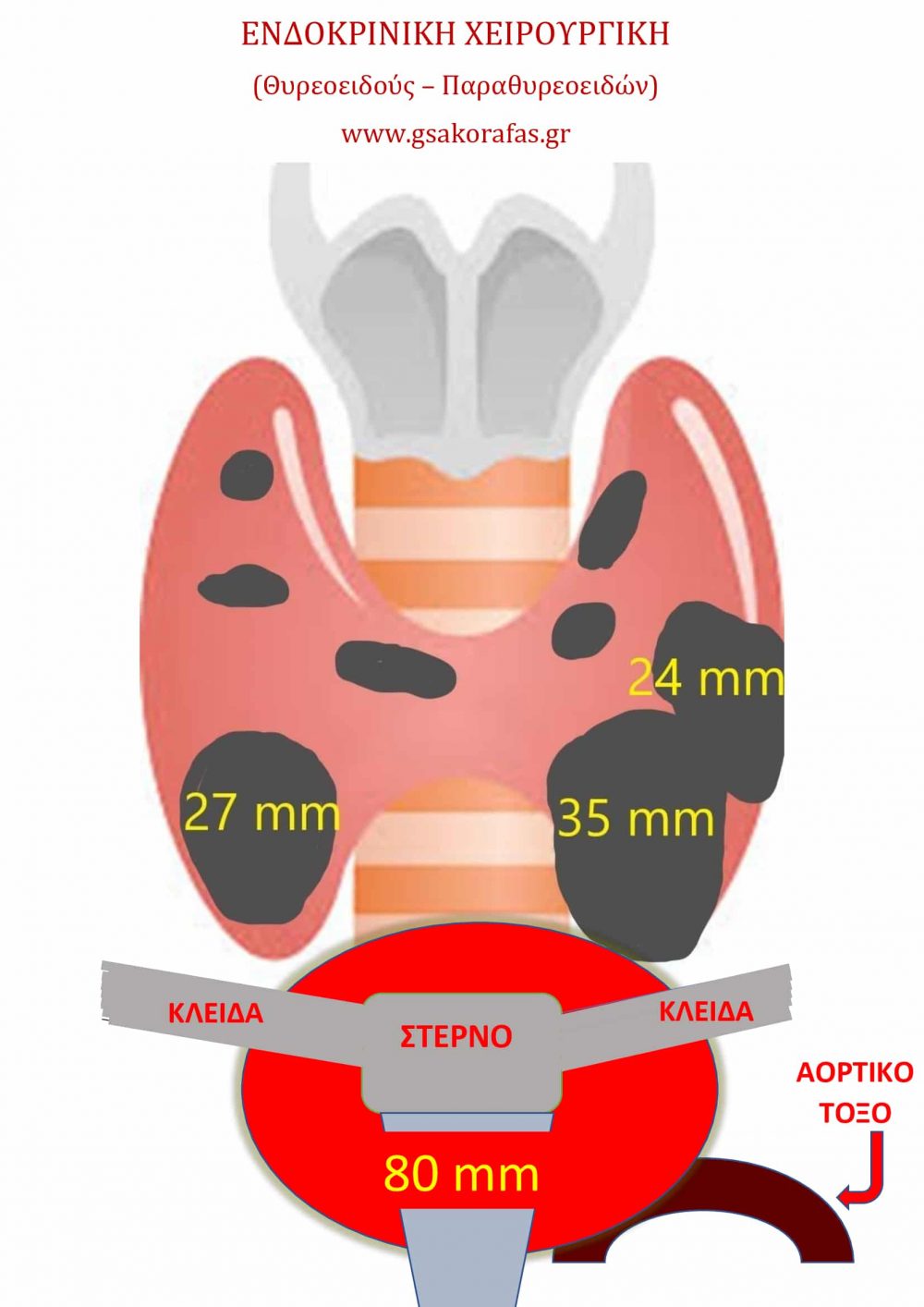 Όζος θυρεοειδούς, γιγάντιος,καταδυόμενος, εξωφυτικός