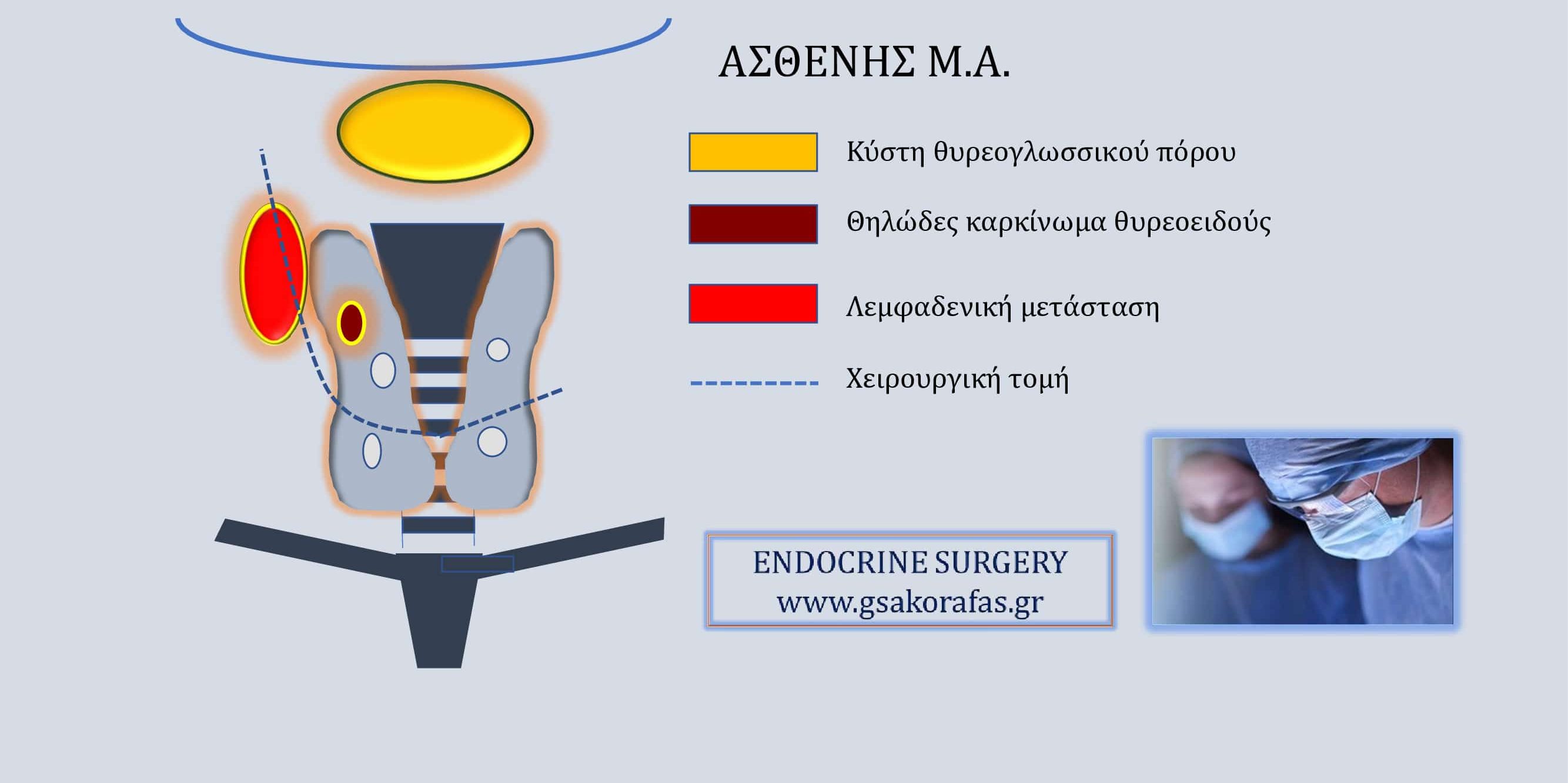 Κύστη θυρεογλωσσικού πόρου και καρκίνος θυρεοειδούς σε 3 ασθενείς μας