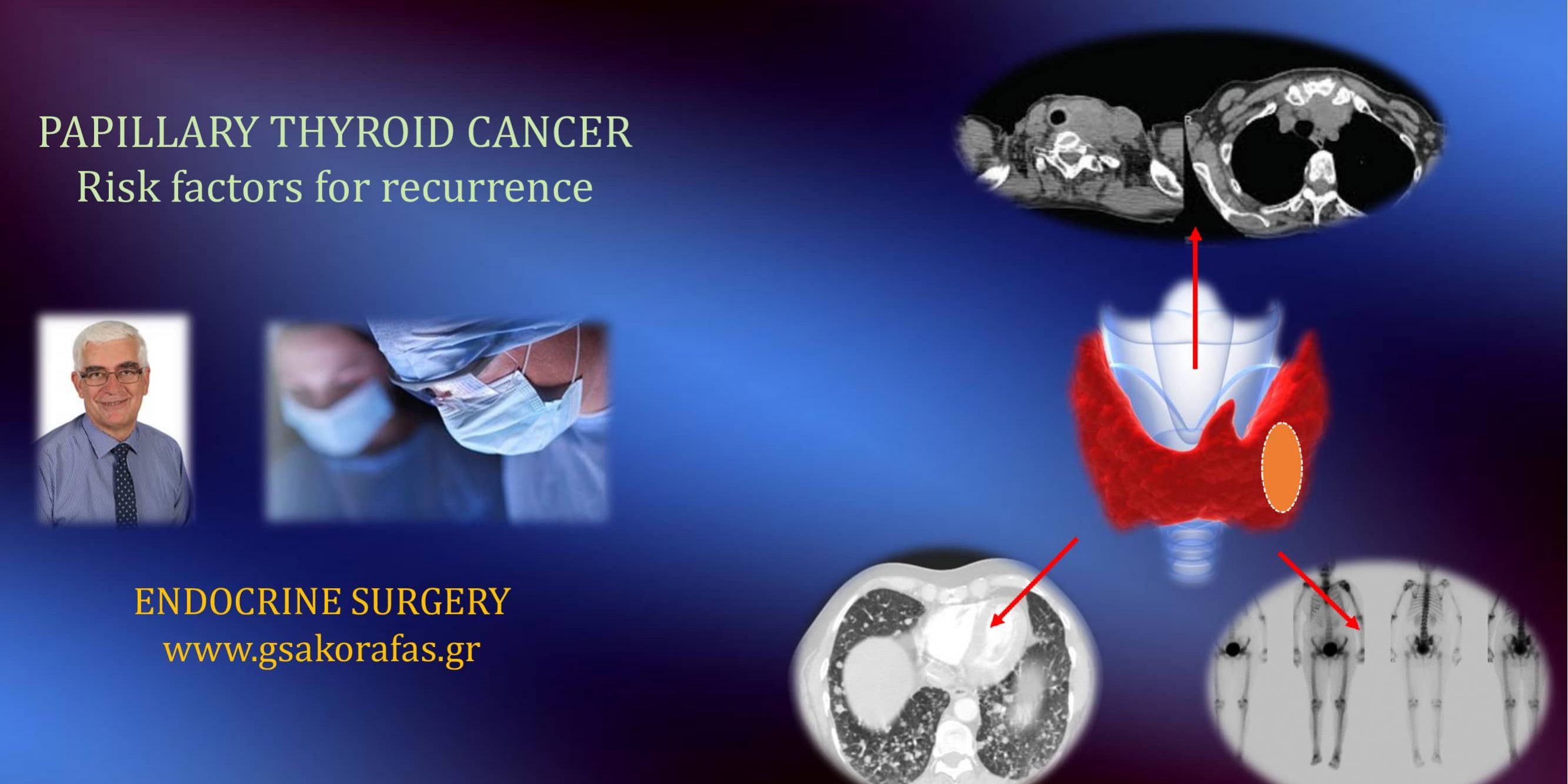 Papillary thyroid cancer and recurrence - risk factors