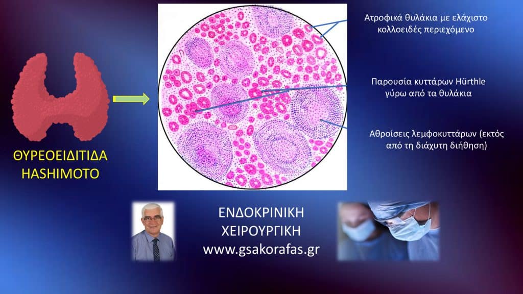 Θυρεοειδίτιδα- Μορφές φλεγμονής του θυρεοειδή αδένα
