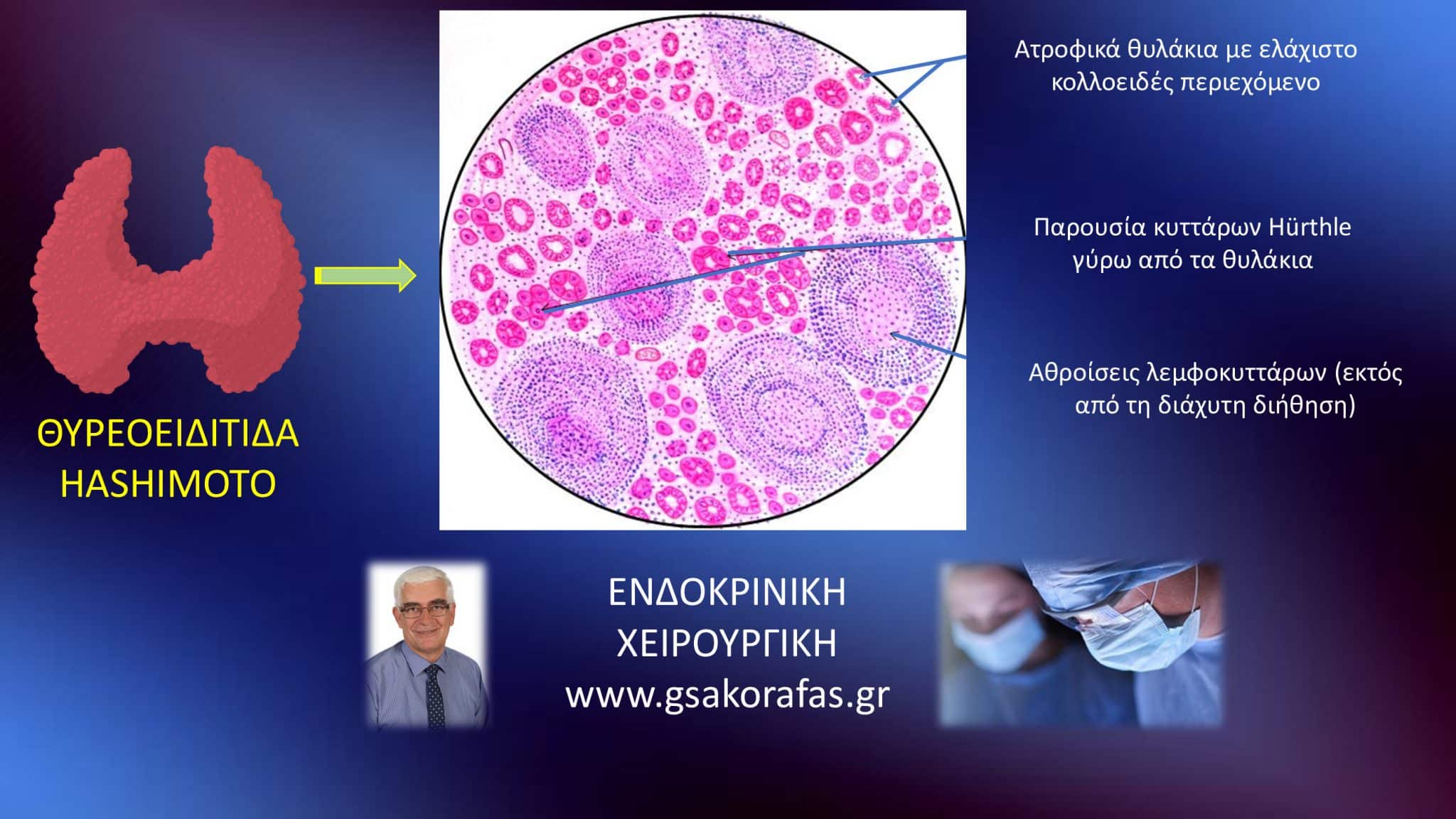 Θυρεοειδίτιδα- Μορφές φλεγμονής του θυρεοειδή αδένα