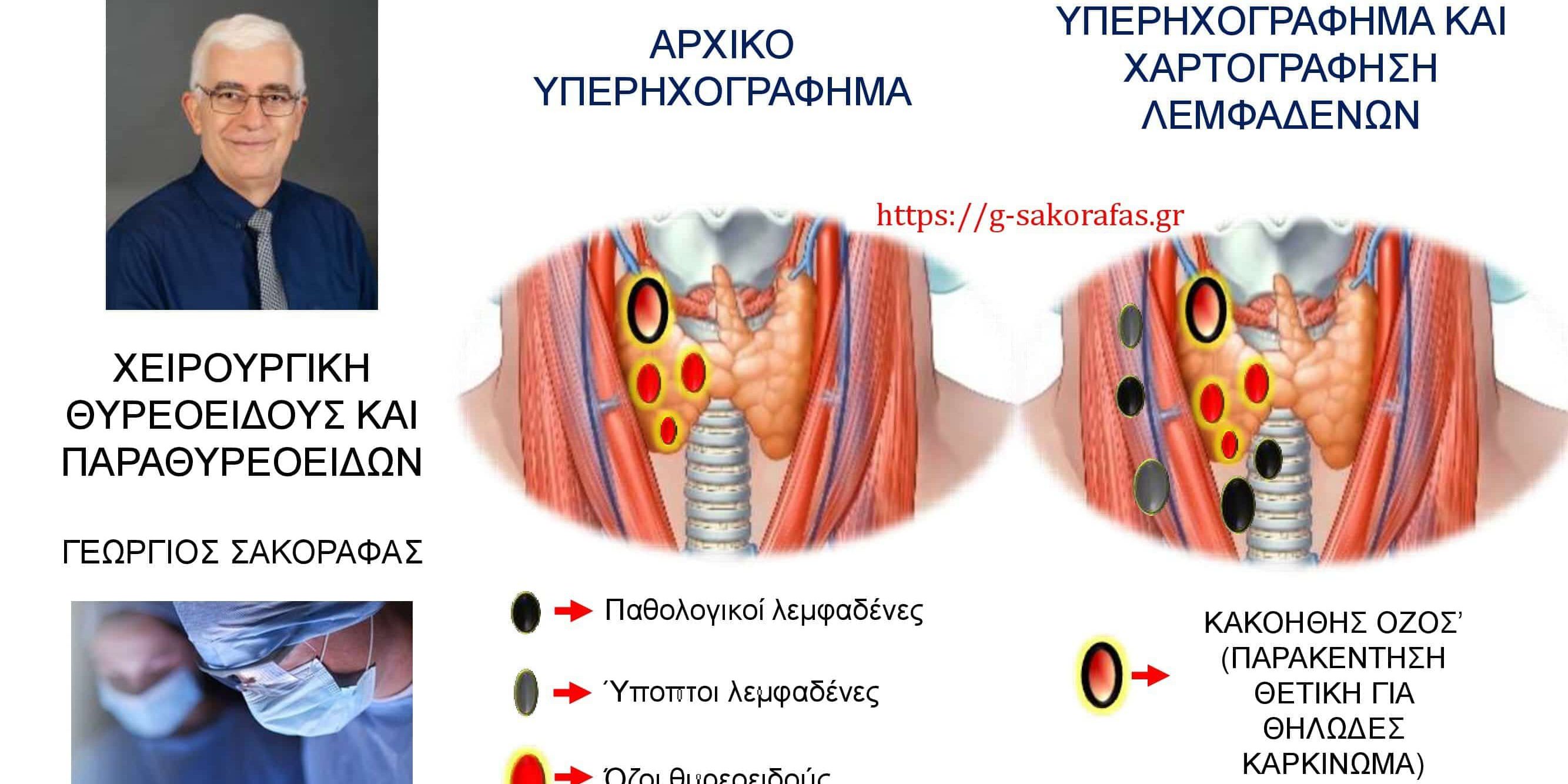 Χαρτογράφηση λεμφαδένων τραχήλου-καρκίνος θυρεοειδούς906