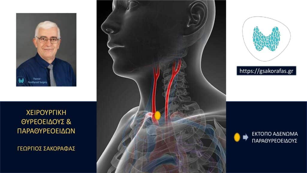 Έκτοπο αδένωμα παραθυρεοειδούς-Εντοπισμός-Αντιμετώπιση9