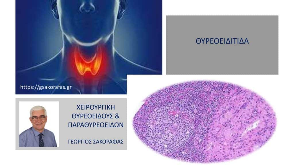 Θυρεοειδίτιδα και λεμφαδένες τραχήλου-Σχέση και σημασία 11