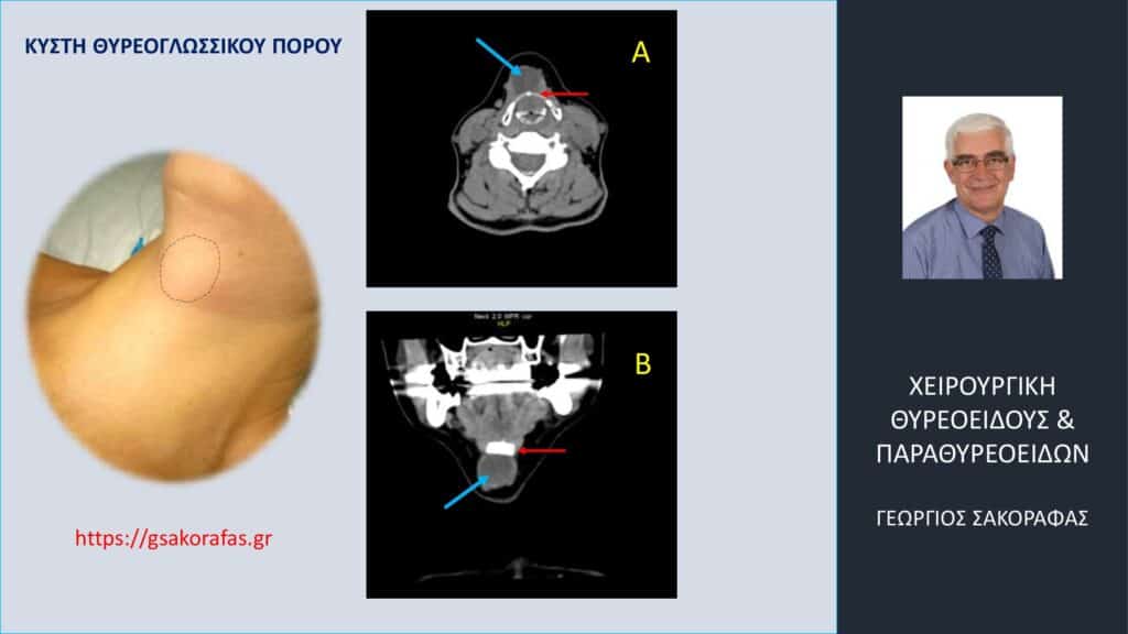 Κύστη θυρεογλωσσικού πόρου -εκτομή με επέμβαση Sistrunk6