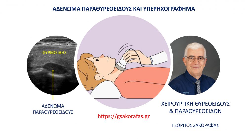 Αδένωμα παραθυρεοειδούς και υπερηχογράφημα - 1η μέθοδος προεγχειρητικού ...