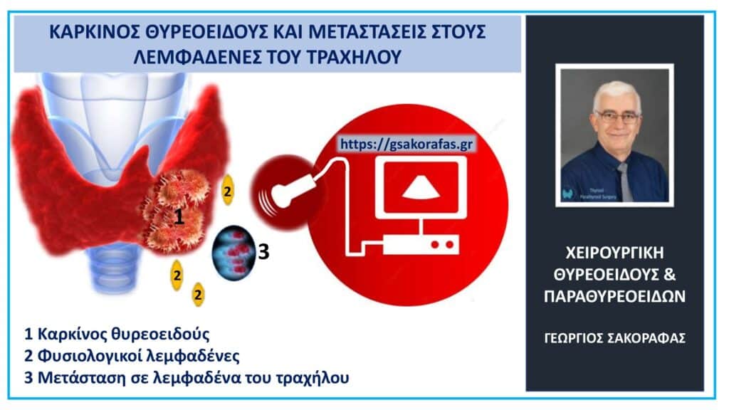 Καρκίνος θυρεοειδούς - μεταστάσεις στους λεμφαδένες 5