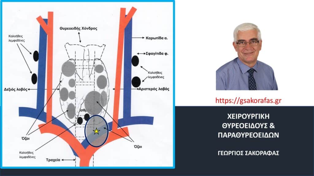 Όζος θυρεοειδούς εξωφυτικός-καταδυόμενος (ασθενής 24 ετών)