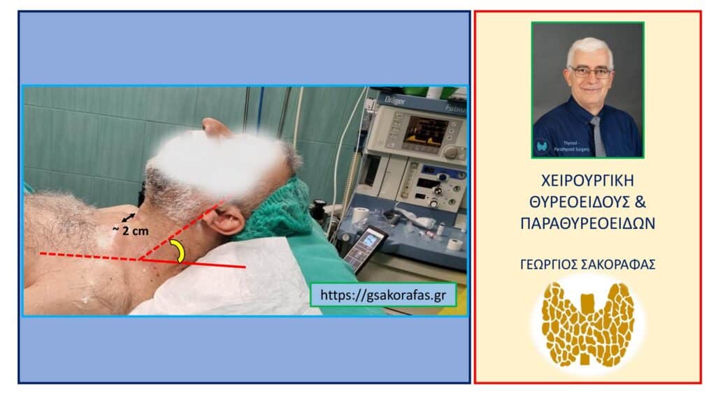 Ολική θυρεοειδεκτομή σε ασθενή με βαριά κύφωση, ετών 63