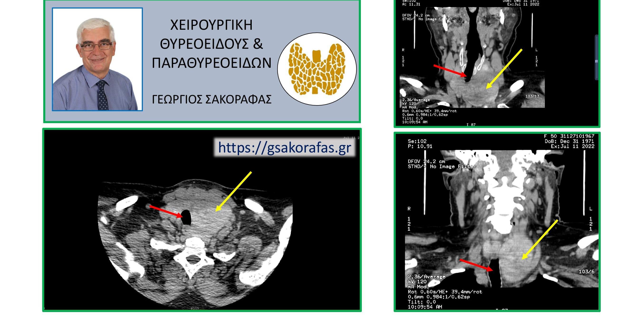 Βρογχοκήλη - λίαν ευμεγέθης - σε ασθενή μας ετών 51