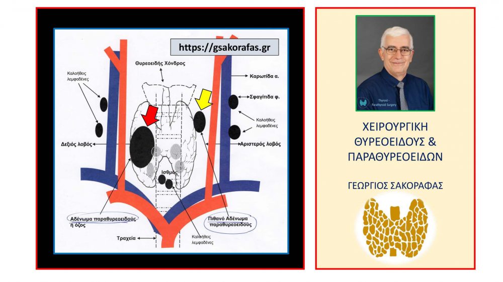Έκτοπο αδένωμα παραθυρεοειδούς - διπλό- σε ασθενή μας ετών 62
