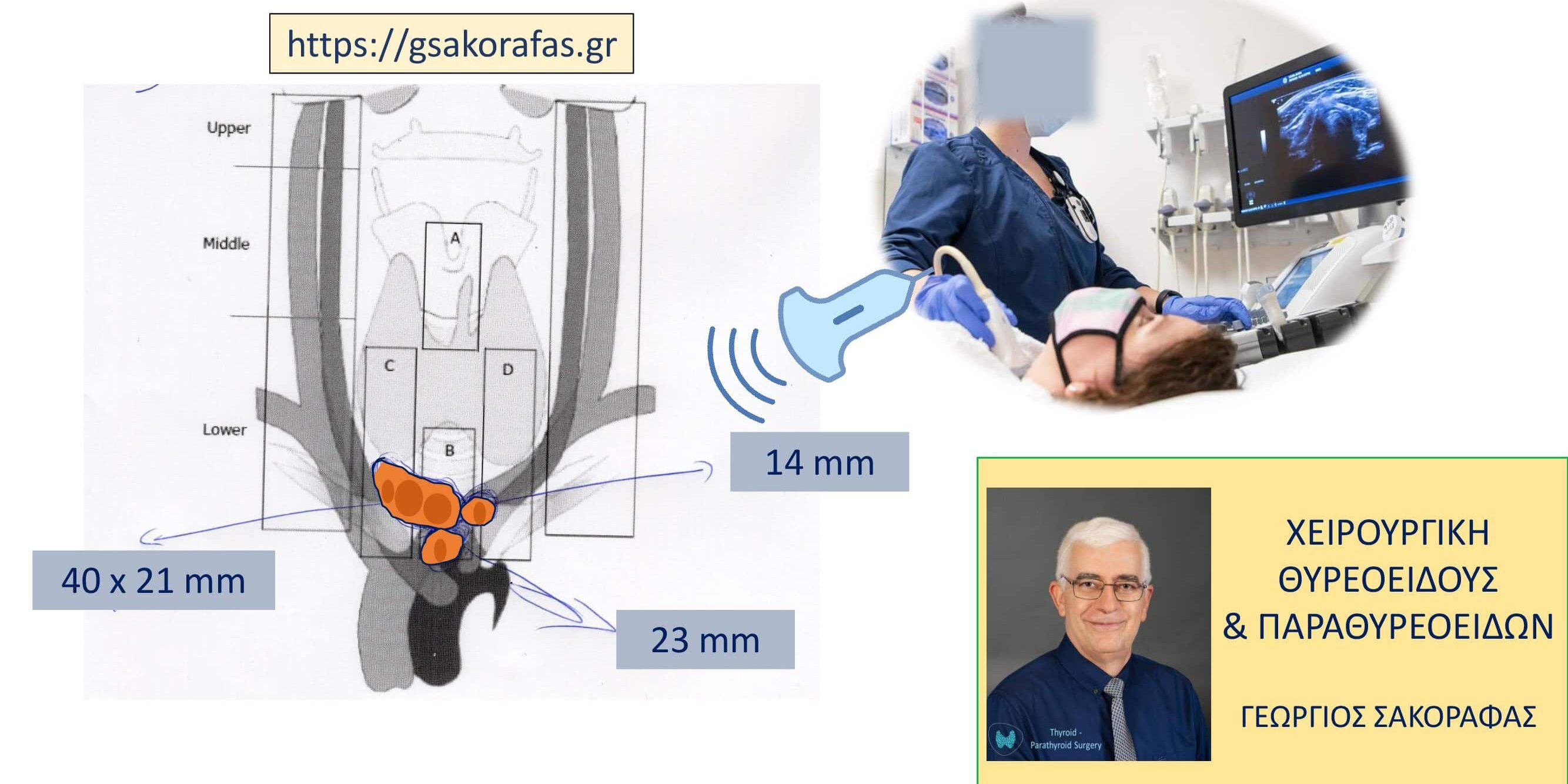 Καρκίνος θυρεοειδούς, θυρεοειδεκτομή και εμπειρία χειρουργού