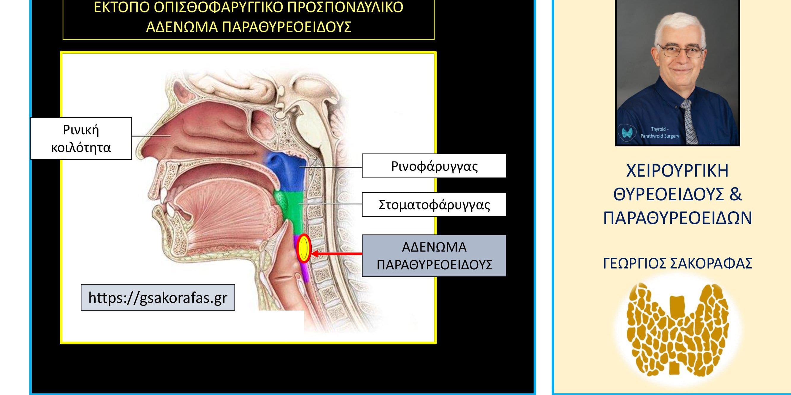 Έκτοπο αδένωμα παραθυρεοειδούς ΄με δύσκολο εντοπισμό σε ασθενή ετών 50