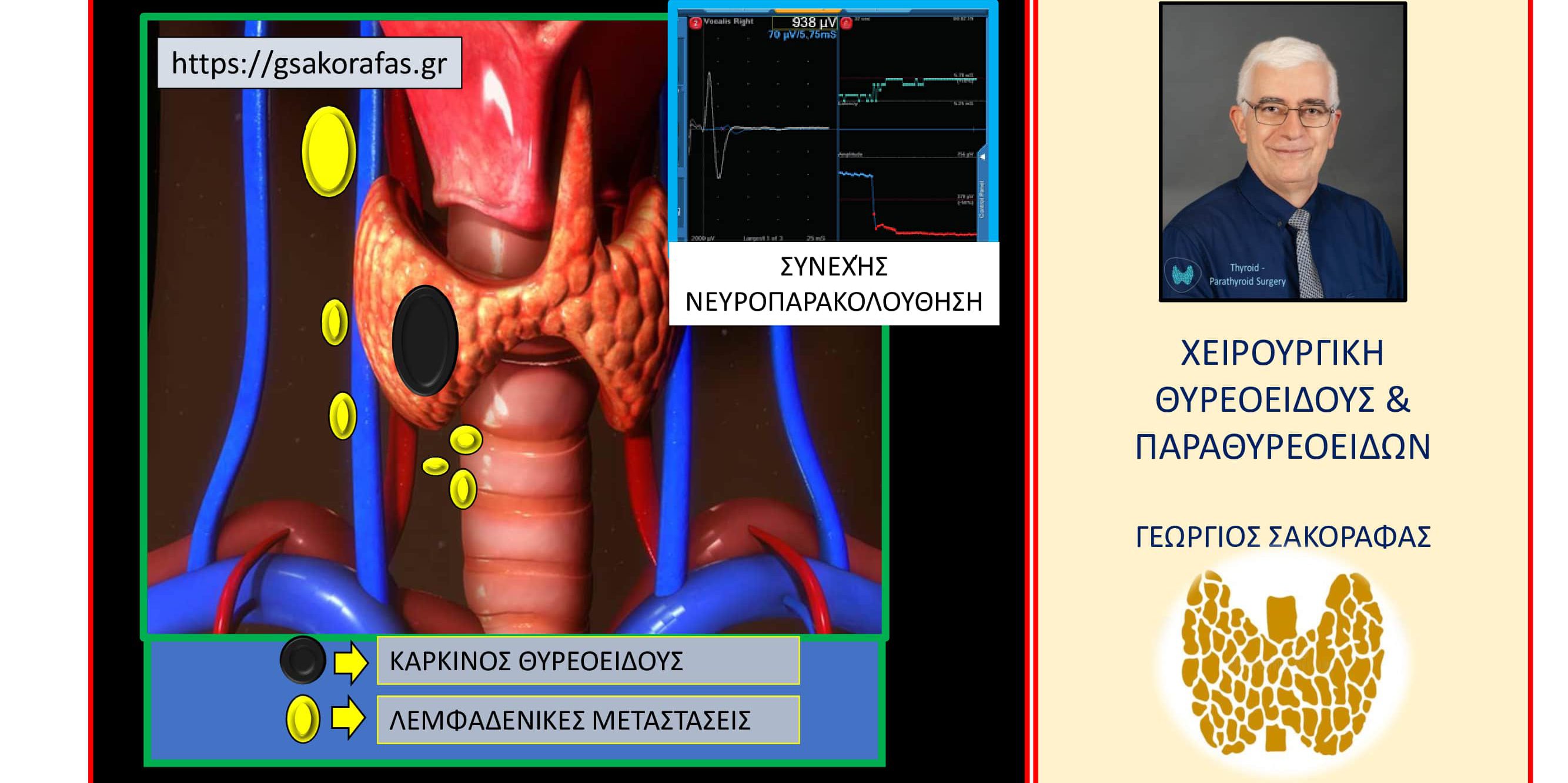 συνεχής νευροπαρακολούθηση - μία άλλη ένδειξη σε ασθενη 54 ετών
