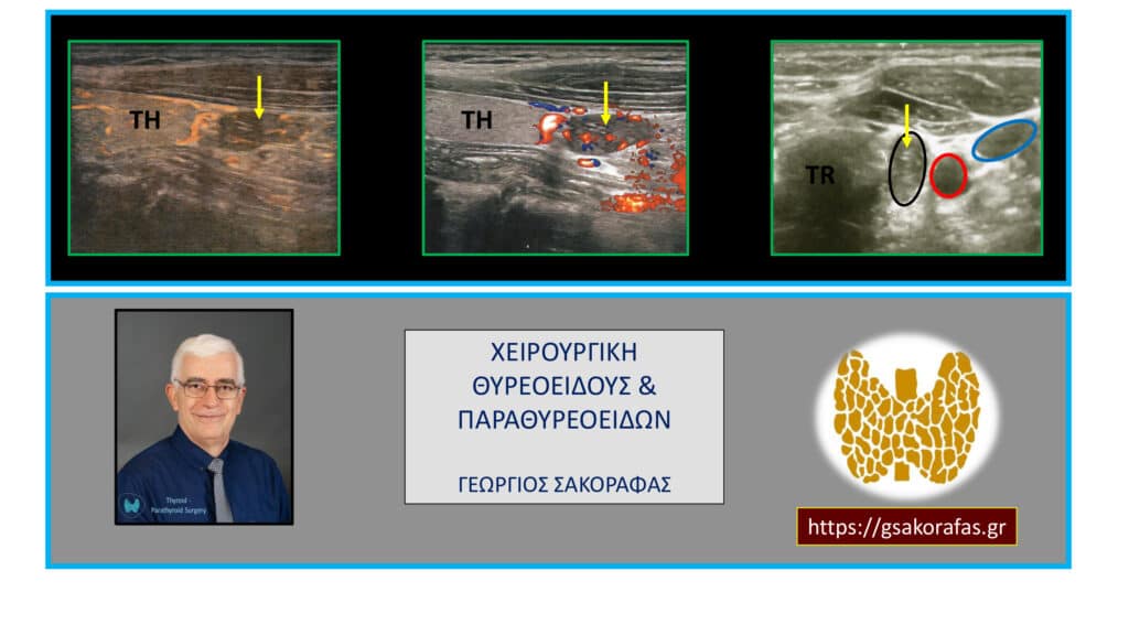 Αδένωμα παραθυρεοειδούς-εικόνες σε ασθενή μας ετών 48