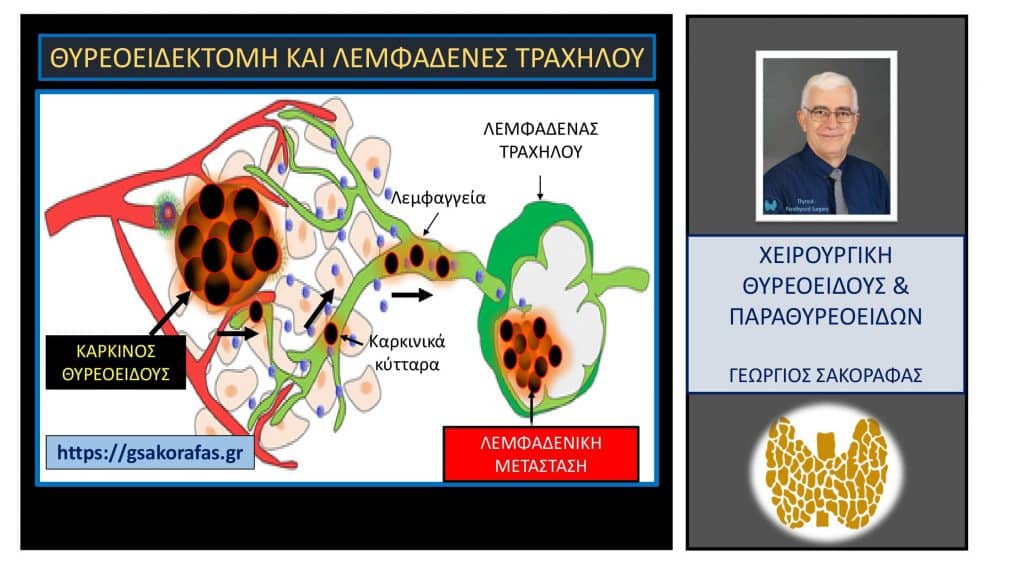 Θυρεοειδεκτομή και λεμφαδένες του τραχήλου-κλινιή σημασία6