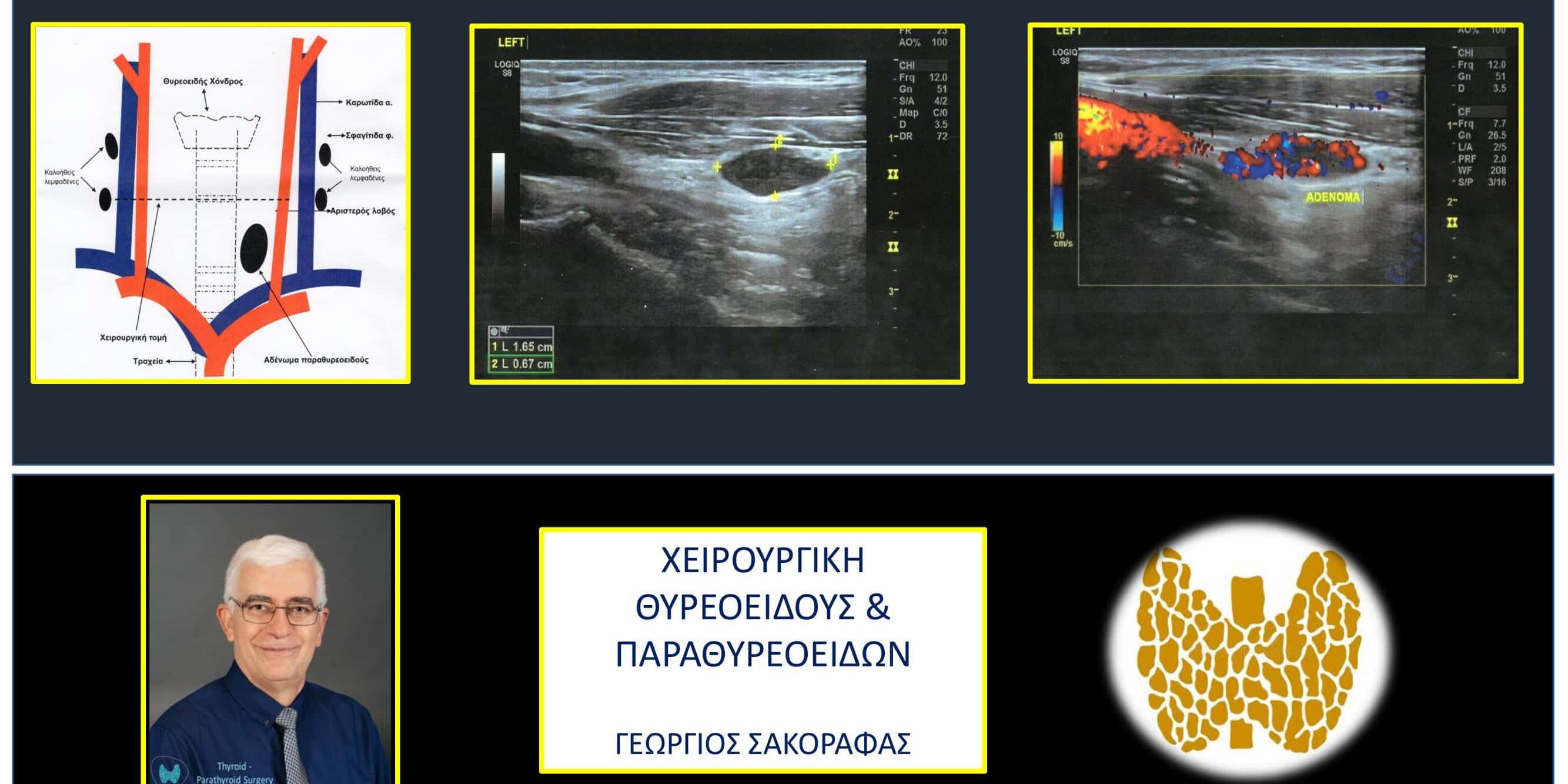 Αδένωμα παραθυρεοειδούς και θυρεοειδεκτομή (προηγηθείσα) σε 44 ετών ασθενή