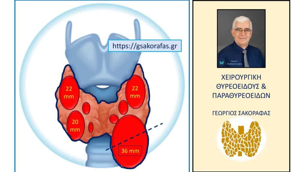 Συμπληρωματική θυρεοειδεκτομή σε ασθενή μας 74 ετών