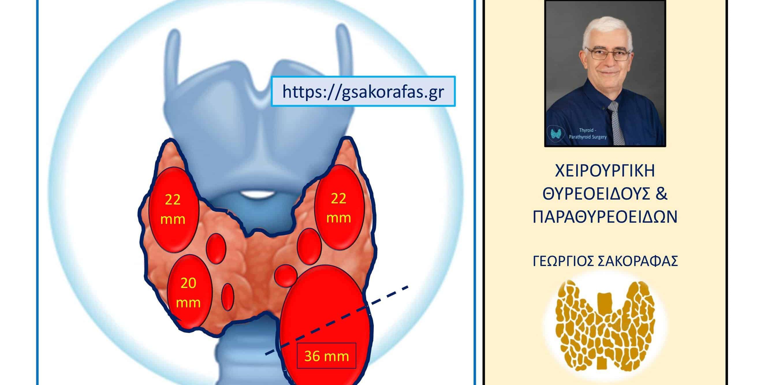 Συμπληρωματική θυρεοειδεκτομή σε ασθενή μας 74 ετών