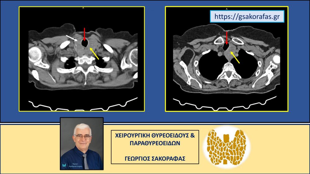 Συμπληρωματική θυρεοειδεκτομή σε ασθενή μας 74 ετών