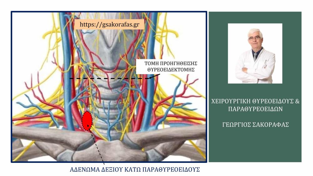 Αφαίρεση παραθυρεοειδούς (παραθυρεοειδεκτομή) σε ασθενή 62 ετών