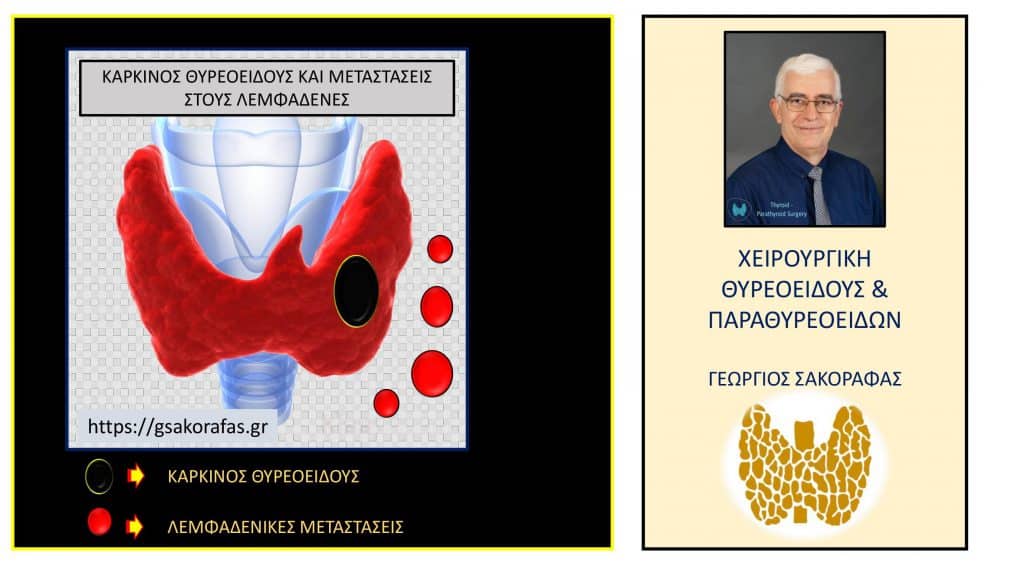 Καρκίνος θυρεοειδούς μεταστάσεις και μέγεθος - συσχέτιση