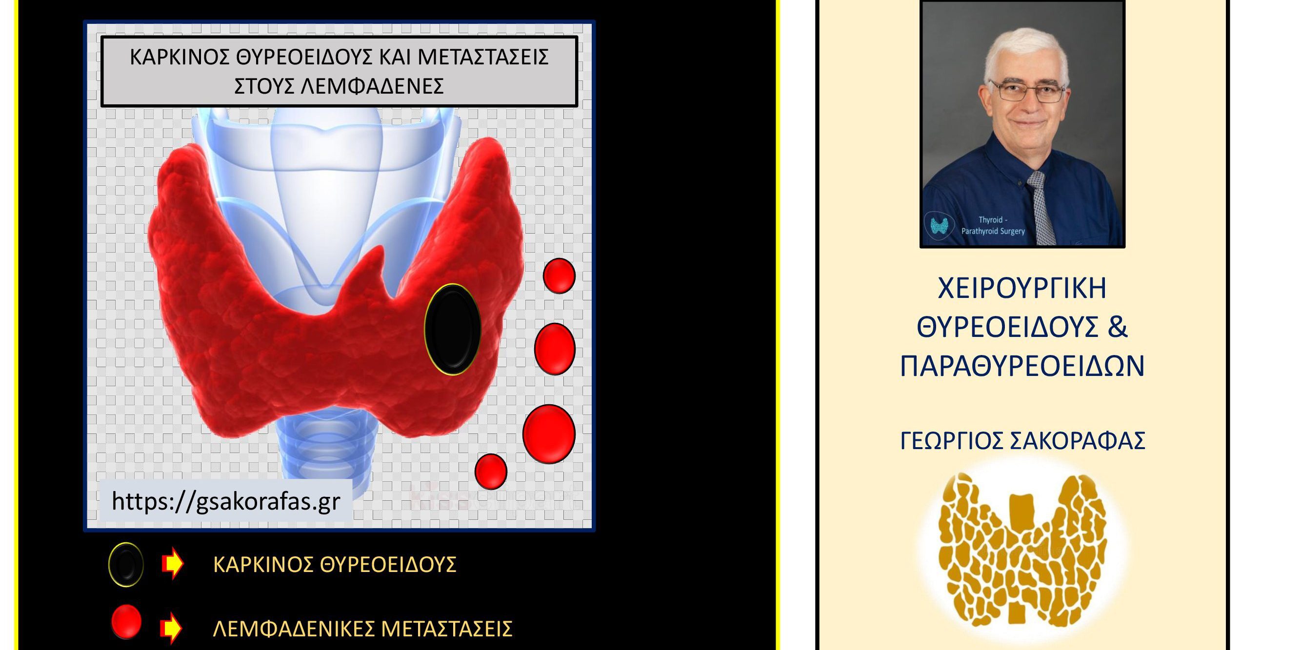 Καρκίνος θυρεοειδούς μεταστάσεις και μέγεθος - συσχέτιση