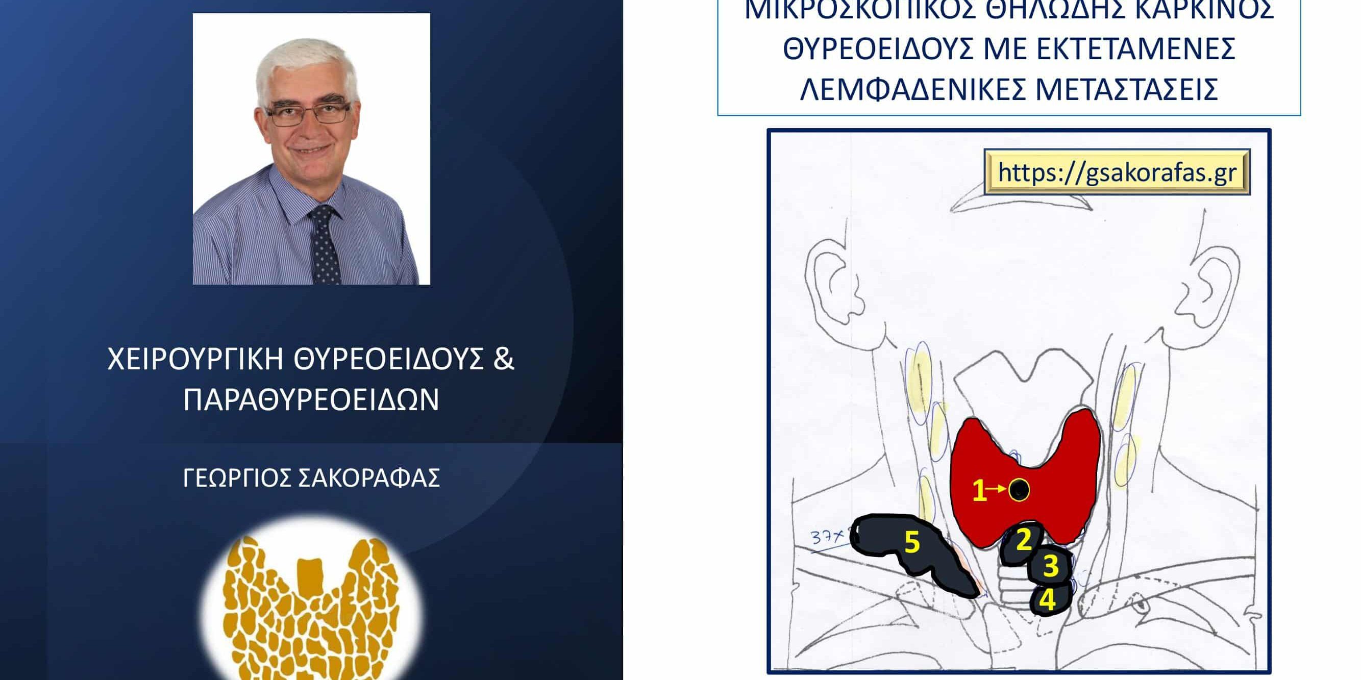 Μικροσκοπικός καρκίνος θυρεοειδούς και μεταστάσεις σε 59 ετών ασθενή