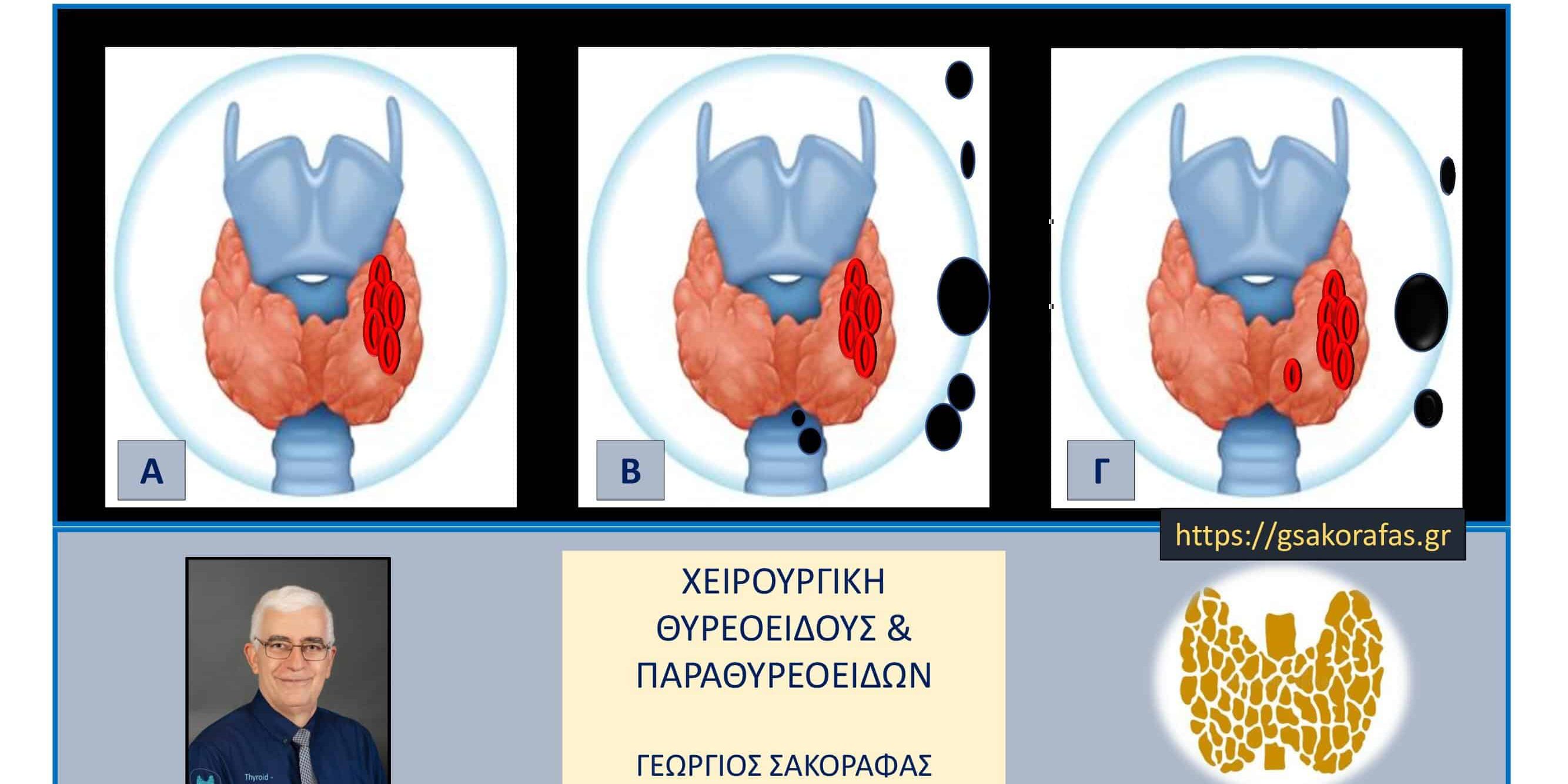 Καρκίνος θυρεοειδούς ασυνεχείς μεταστάσεις σε λεμφαδένες σε 37χρονη