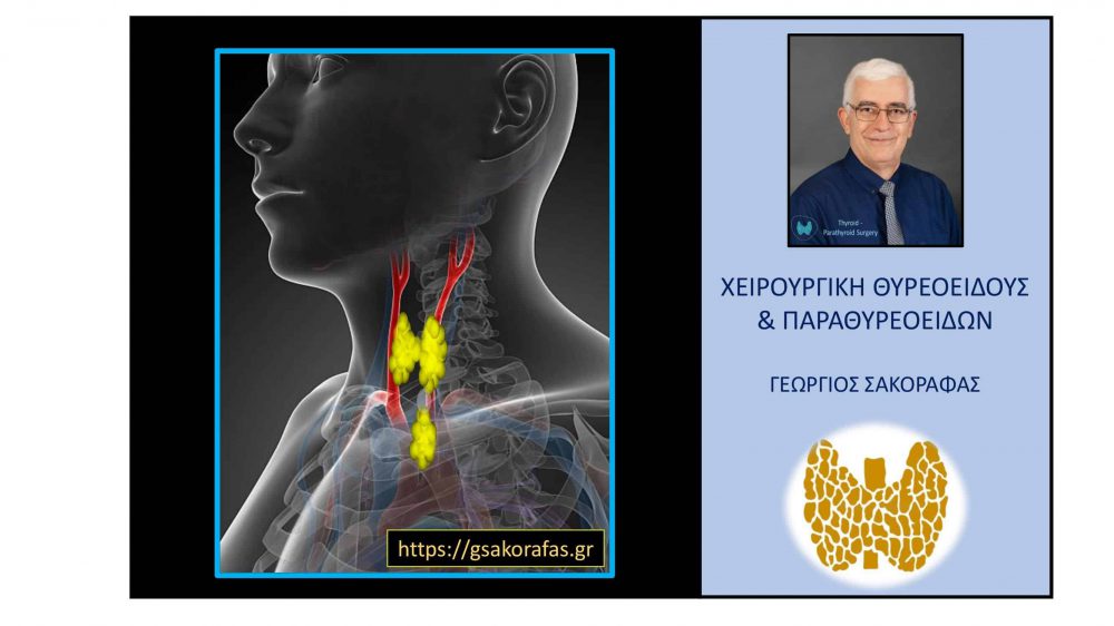 Όζος θυρεοειδούς πλήρως εξωφυτικός καταδυόμενος σε ασθενή 51 ετών