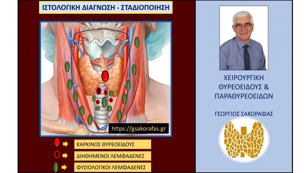 Καρκίνος θυρεοειδούς προβληματισμοί -σε ασθενή μας 28 ετών
