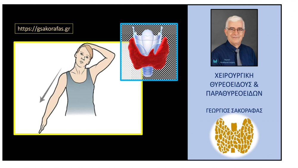 Θυρεοειδεκτομή και αυχεναλγία - 4 ασκήσεις αποκατάστασης
