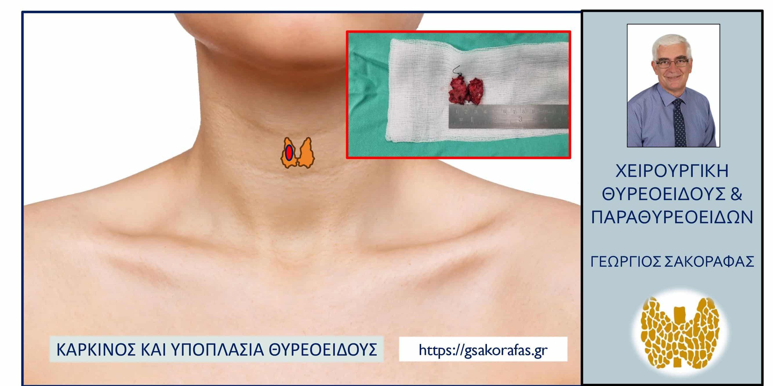 Υποπλασία και καρκίνος θυρεοειδούς σε ασθενή μας 36 ετών