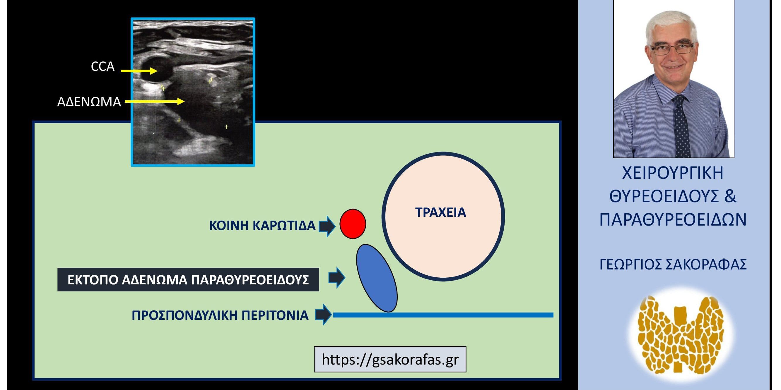 Έκτοπο αδένωμα παραθυρεοειδούς (προσπονδυλικό) σε 37ετων ασθενή