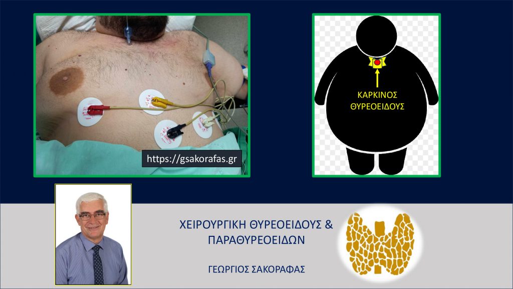 Καρκίνος θυρεοειδούς και βαριά νοσογόνος παχυσαρκία