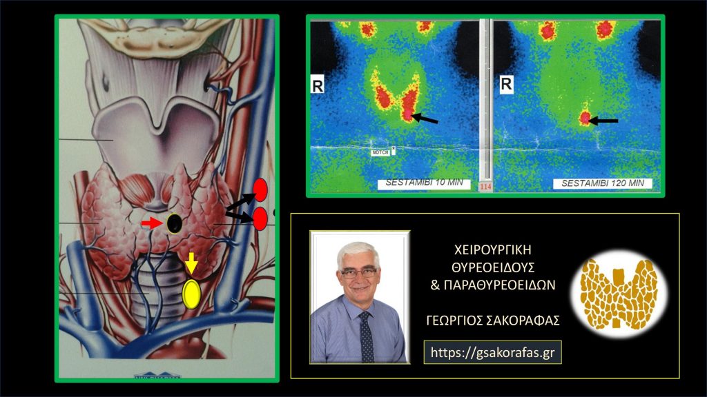 Καρκίνος θυρεοειδούς-συνδυασμένη επέμβαση σε ασθενή μας