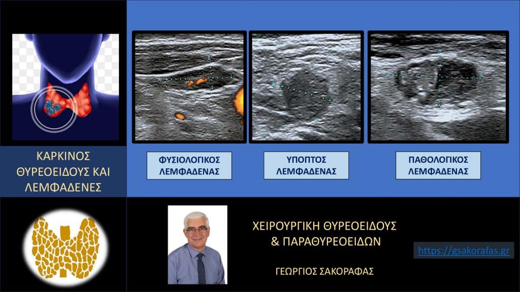 Καρκίνος θυρεοειδούς και λεμφαδένες – ταξινόμηση