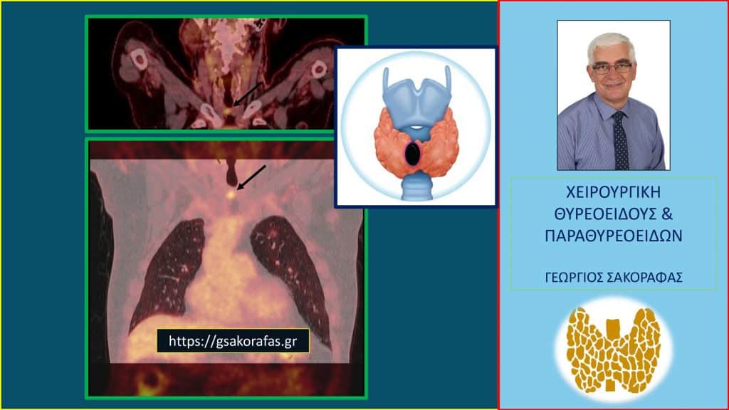 Καρκίνος θυρεοειδούς σε PET scan - εικόνες (ασθενής μας)