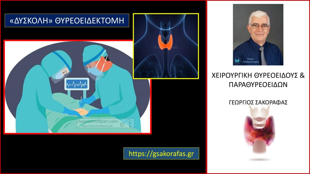 Δύσκολη θυρεοειδεκτομή – πότε η επέμβαση είναι «δύσκολη»