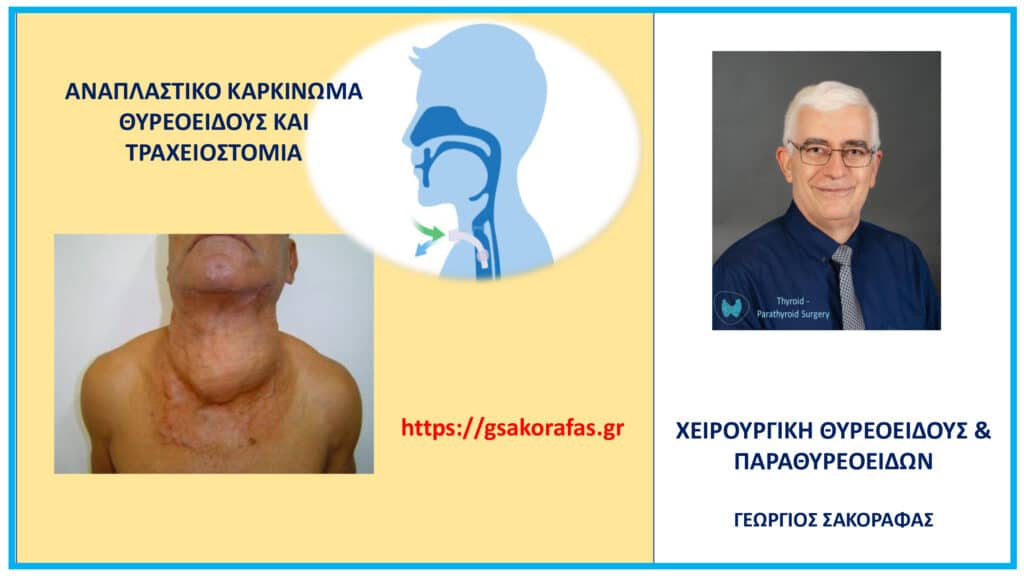 Αναπλαστικός καρκίνος θυρεοειδούς και τραχειοστομία