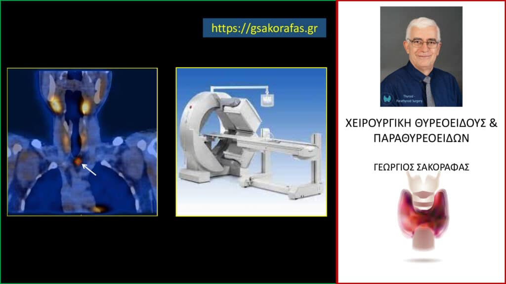 Αδένωμα παραθυρεοειδούς και SPECT-CT scan