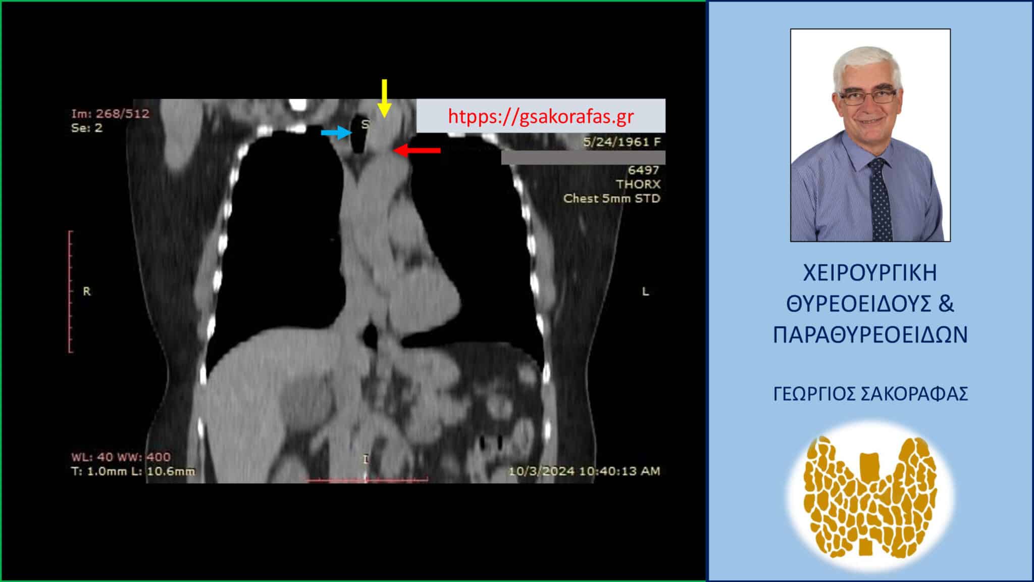 Χειρουργός Θυρεοειδούς Σακοράφας Γεώργιος, Αθήνα