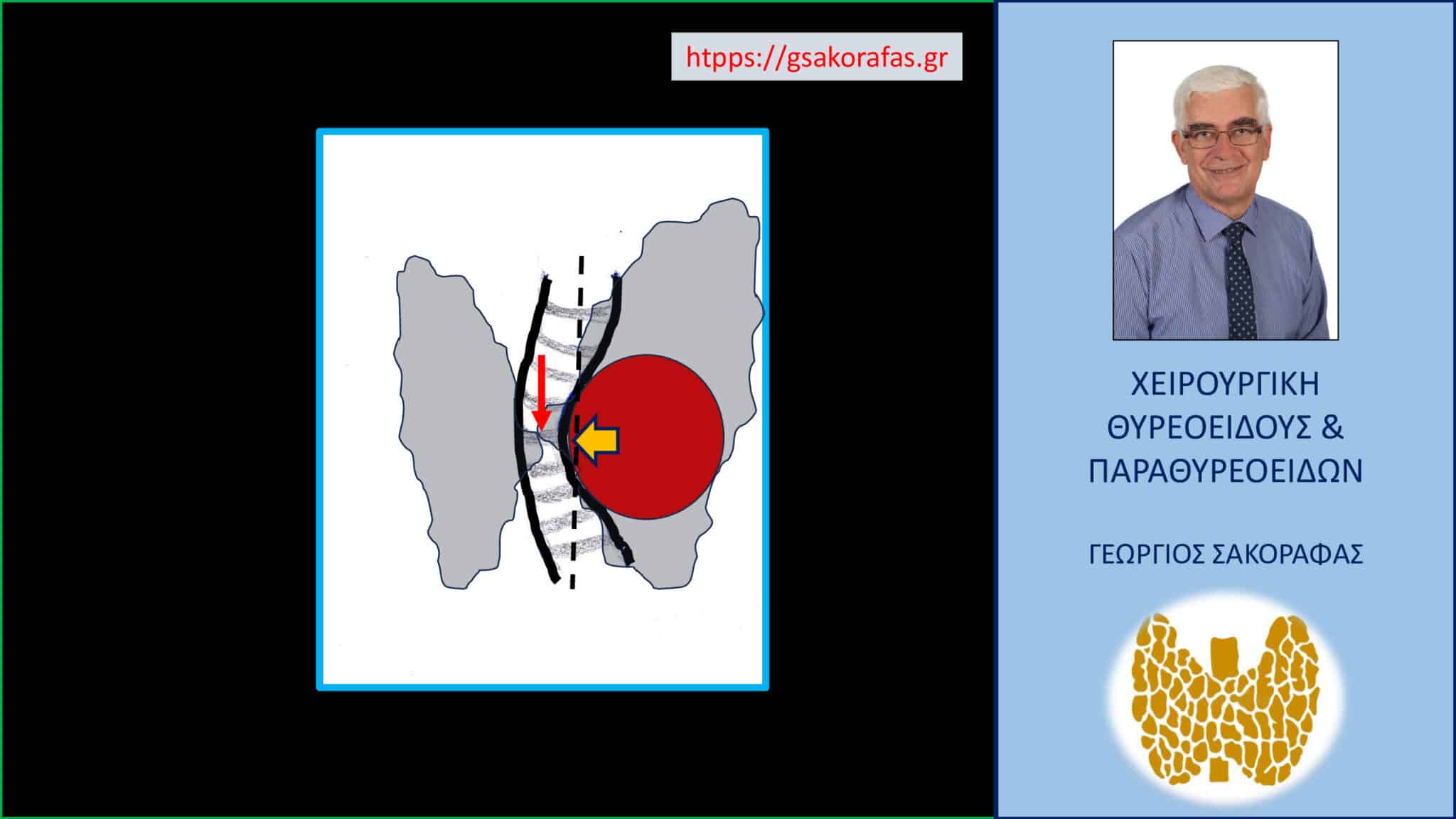 Όζοι Θυρεοειδούς: Αιτίες, Συμπτώματα & Τρόποι Αντιμετώπισης